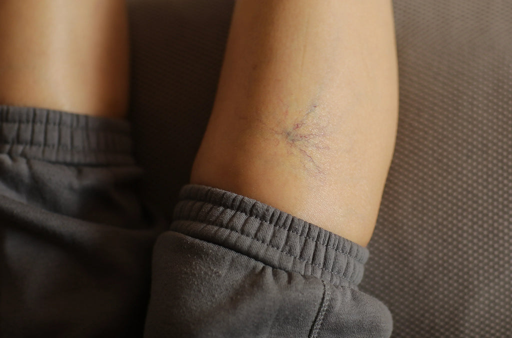 What is Phlebitis in the Legs? Causes, Symptoms and Treatment – Doc Miller