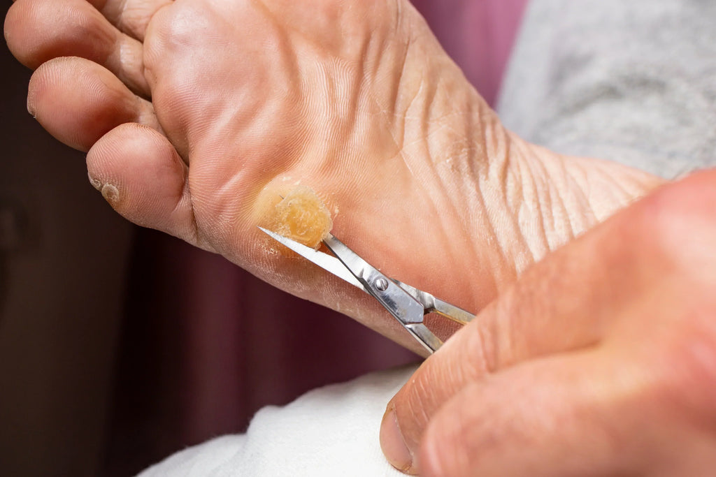 How to Get Rid of Foot Calluses Safely – Doc Miller